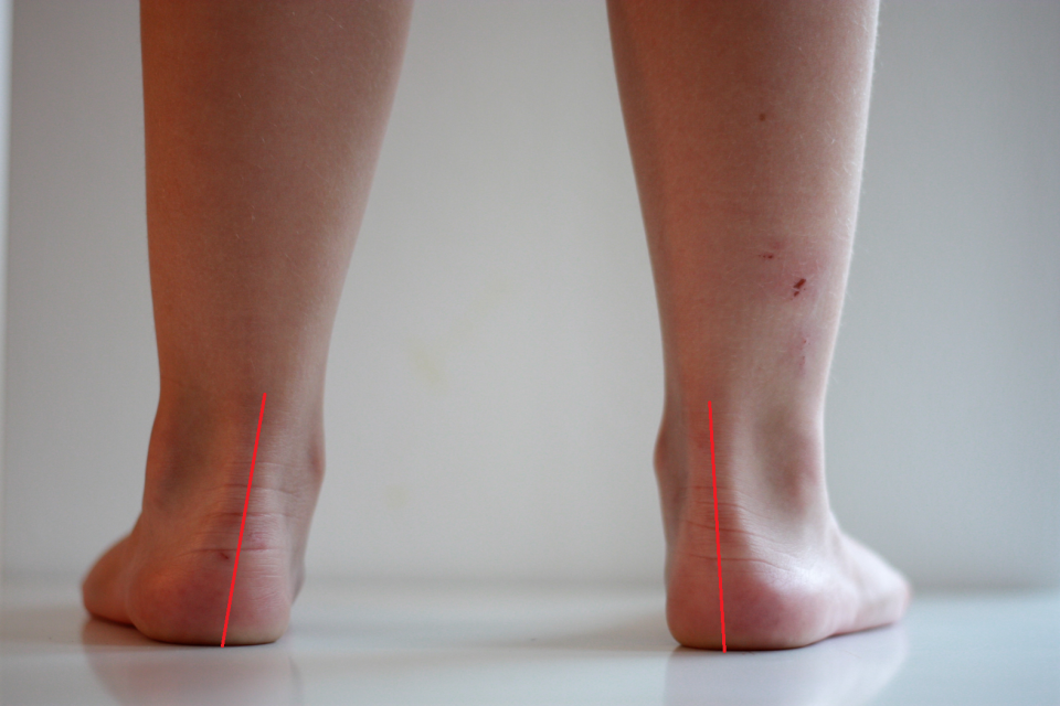 Der kindliche Knick-Senkfuß - Kidfoot