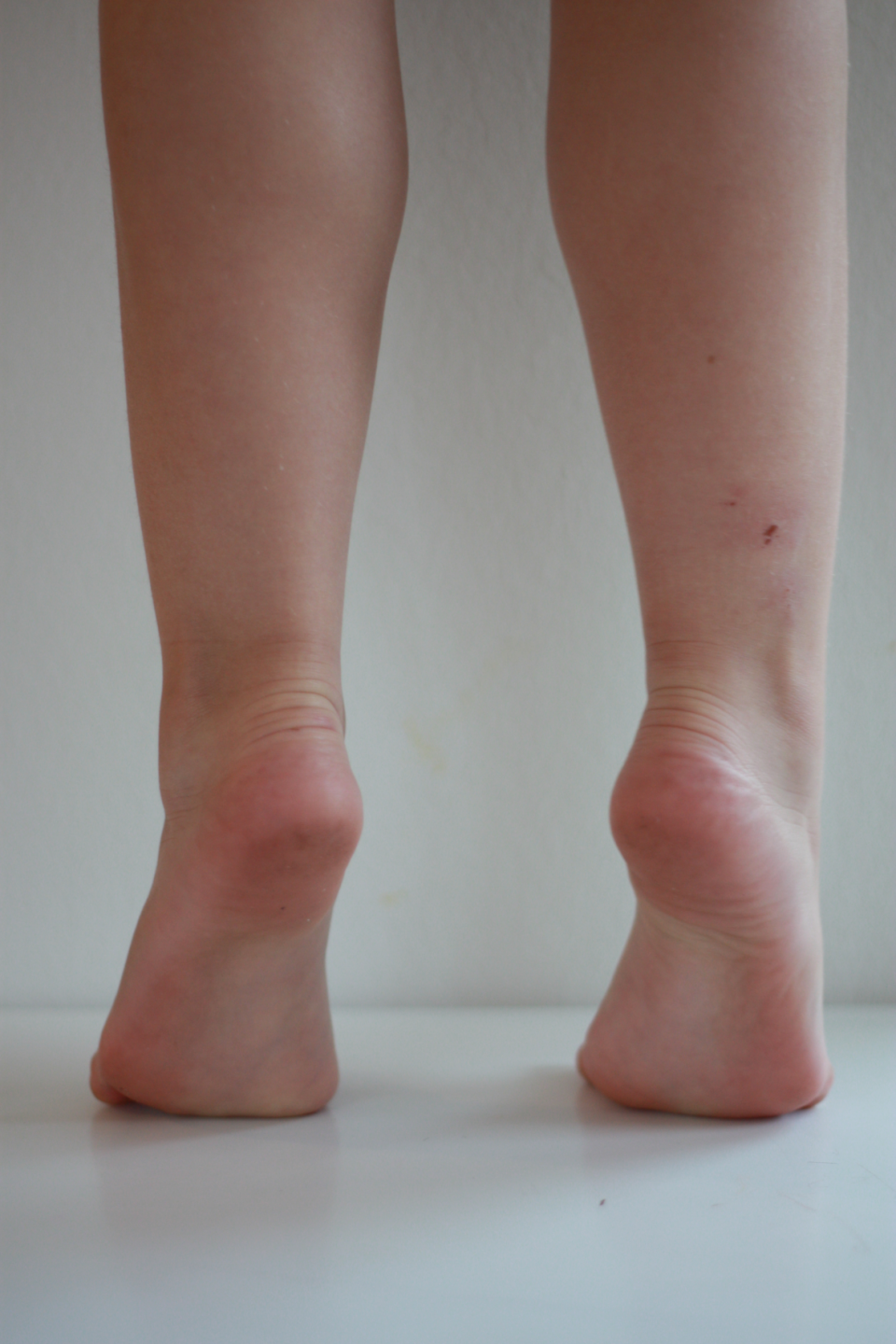 Der kindliche Knick-Senkfuß - Kidfoot